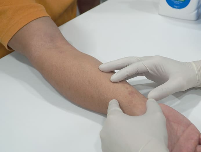 Stigma, shame and stress: The effects of sensitive, eczema-prone skin ...