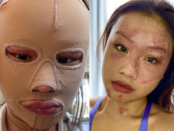 Burn survivor Charlene Chew on fitness and 'inner work'