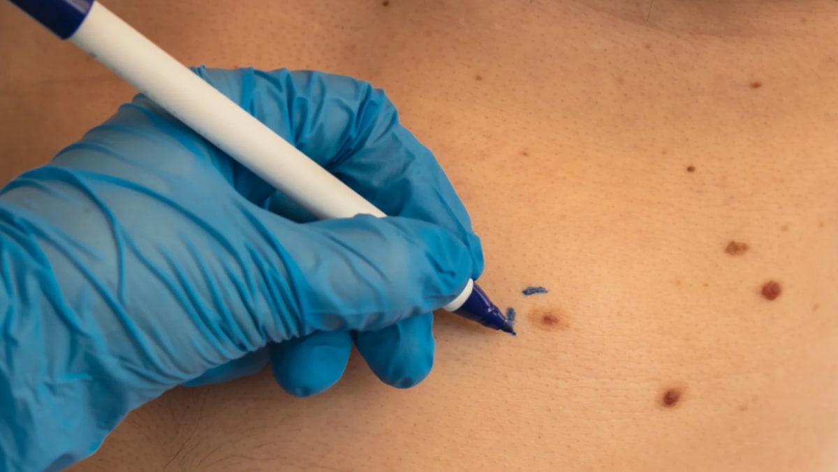 Benarkah tahi lalat tanda awal barah kulit? Ini kata pakar... - BERITA ...