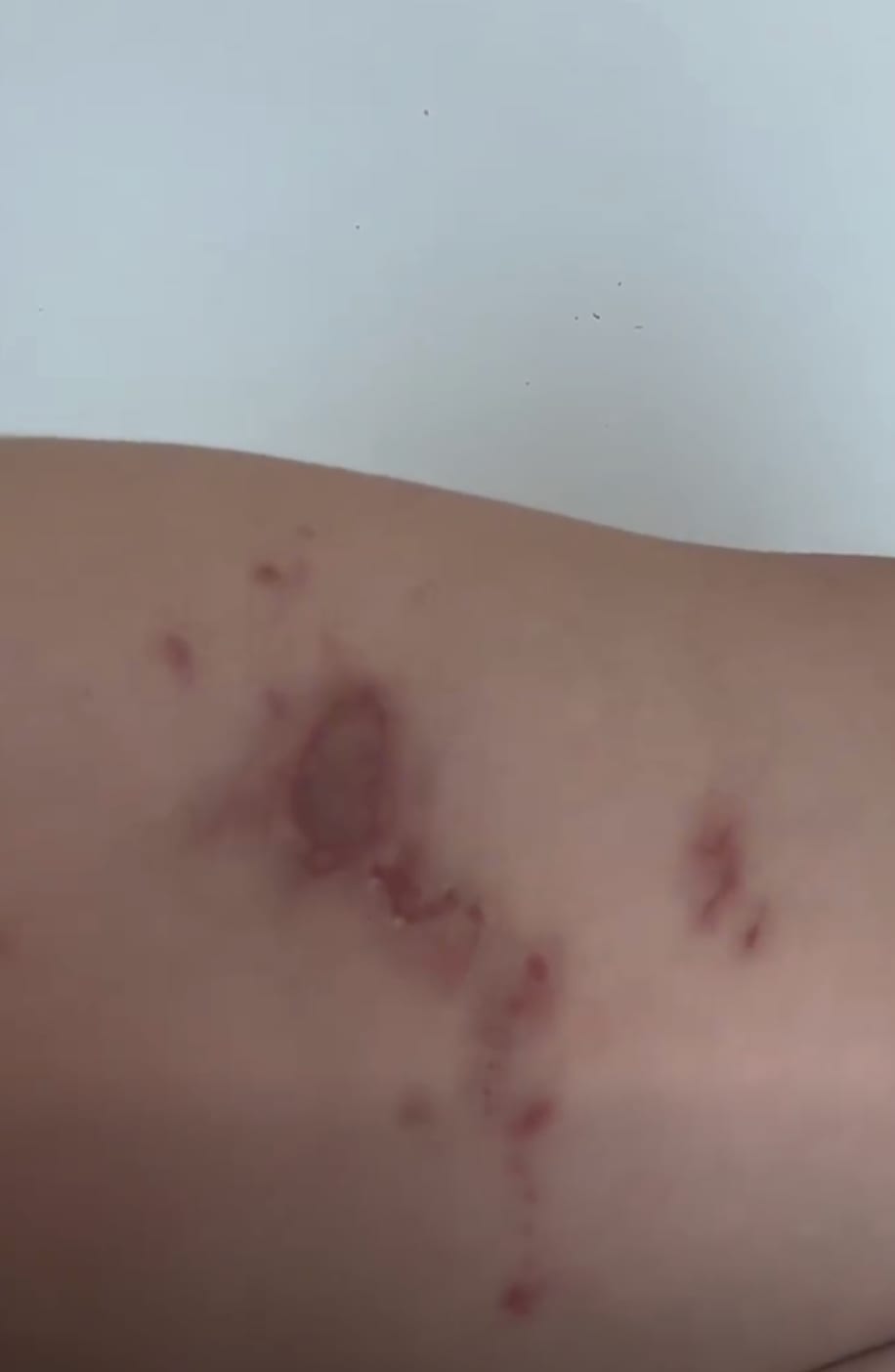 Sleeping Naked Left Jaspers Lai With Painful Blisters After Charlie Ant ...