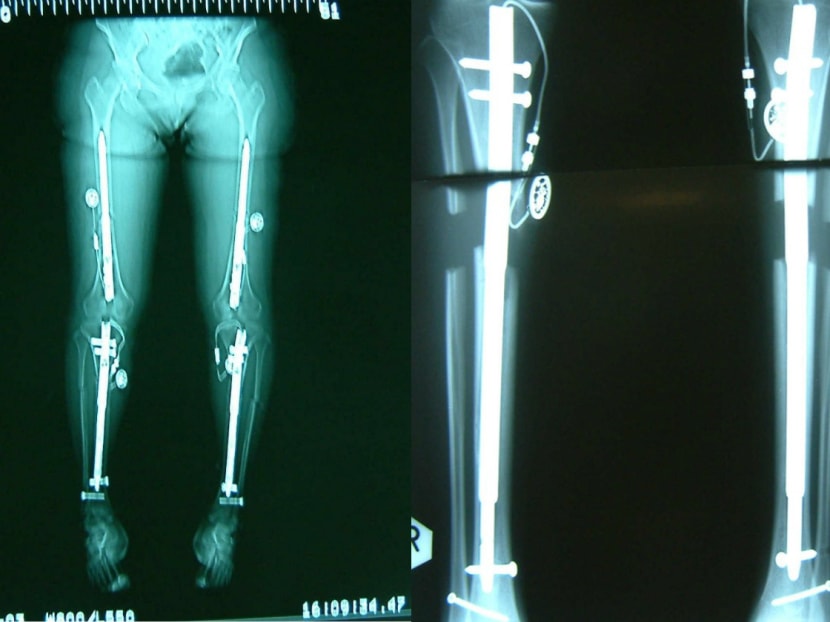 how to grow tibia bone