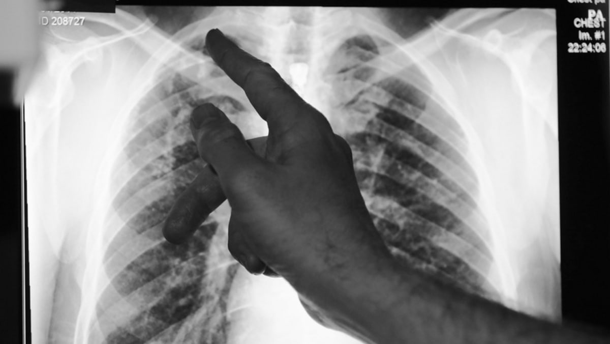 Staying ahead in the fight against tuberculosis - CNA Lifestyle