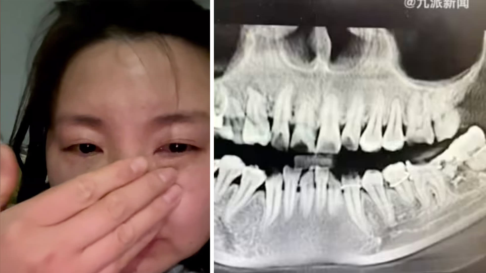 Wisdom Teeth In Chinese