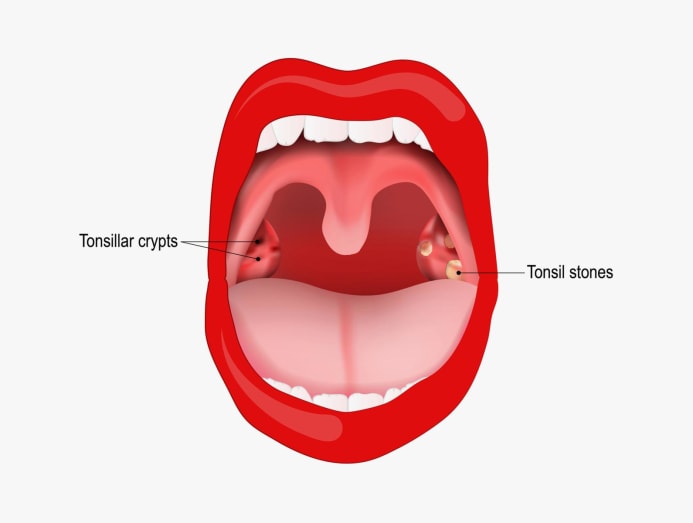 What are tonsil stones and do they need to be removed? - CNA Lifestyle