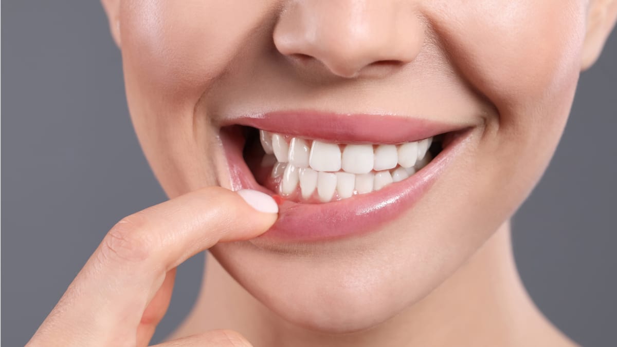Does rubbing salt on mouth ulcers work? What you need to know about ...