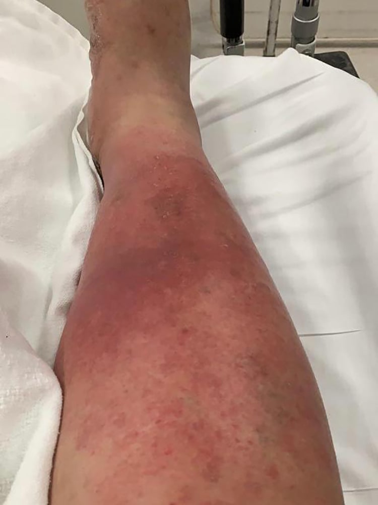 Women and heart health: What is atrial fibrillation and why is more ...