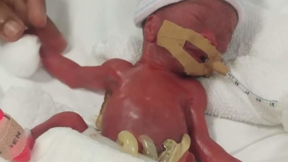 World’s smallest baby, born at 212 grams at NUH, now doing well at 14 ...