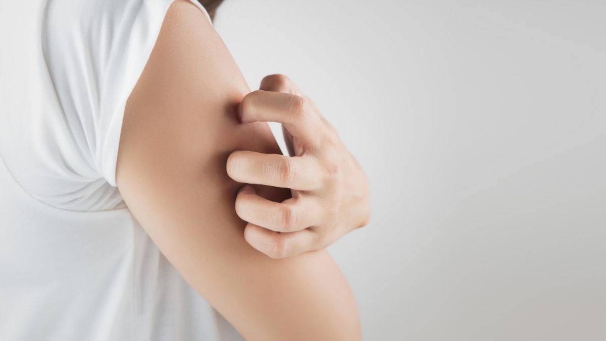 Why do you suddenly feel itchy? Why does scratching feel good? - CNA ...