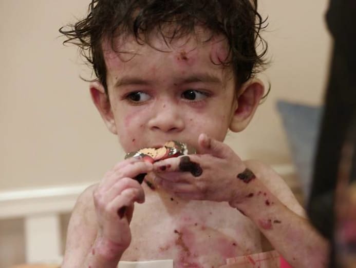 Singapore’s butterfly children, born with ‘the worst disease you’ve ...