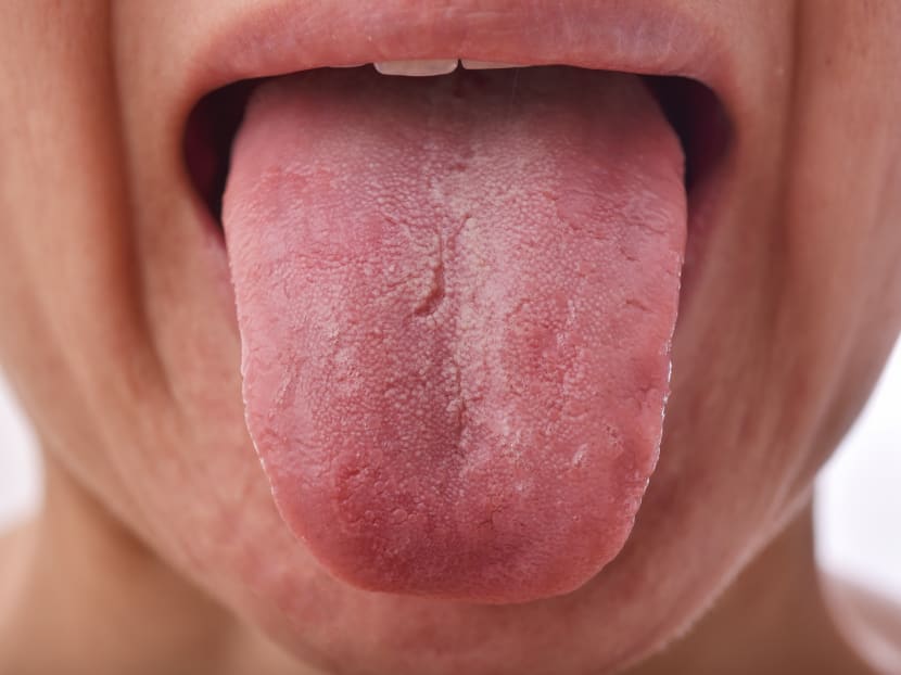 normal tongue