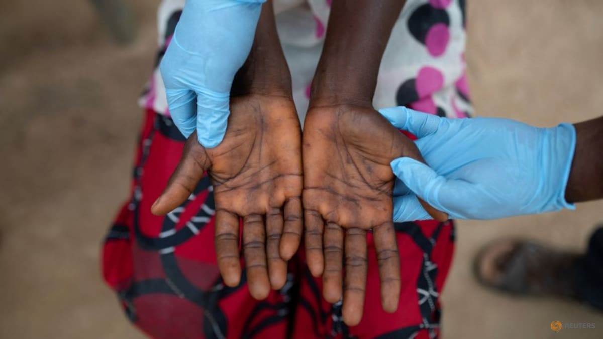 Stigma, regulatory barriers delay mpox response in country that needs ...