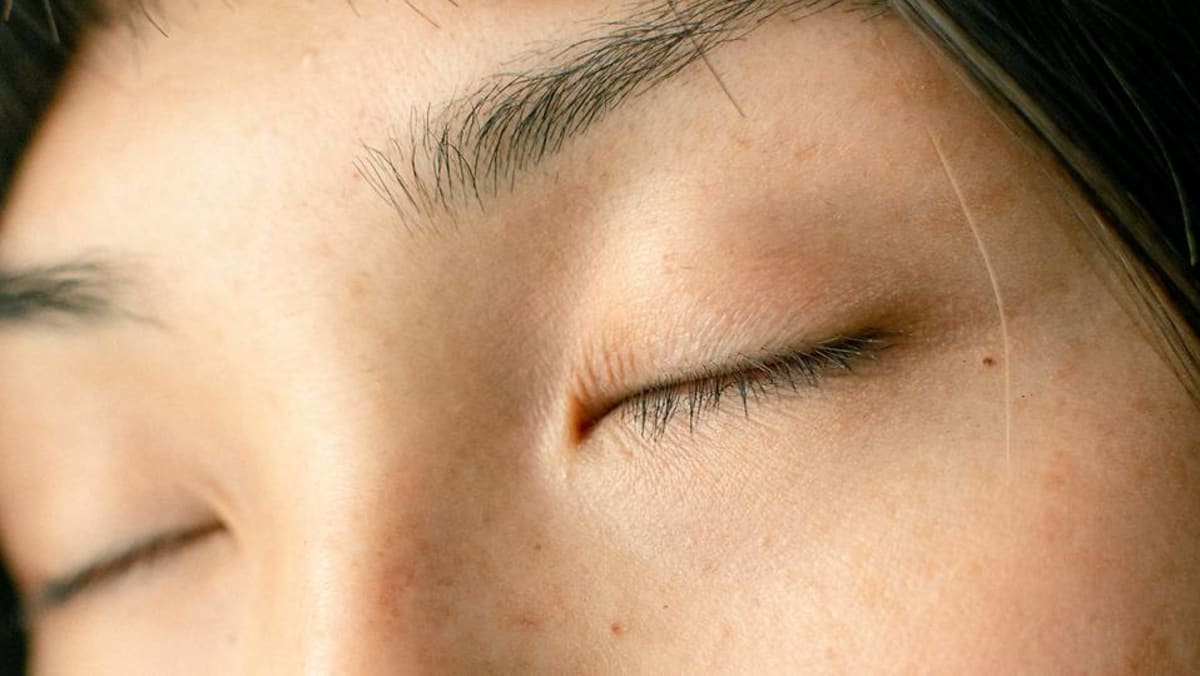 outer eyebrows hypothyroidism