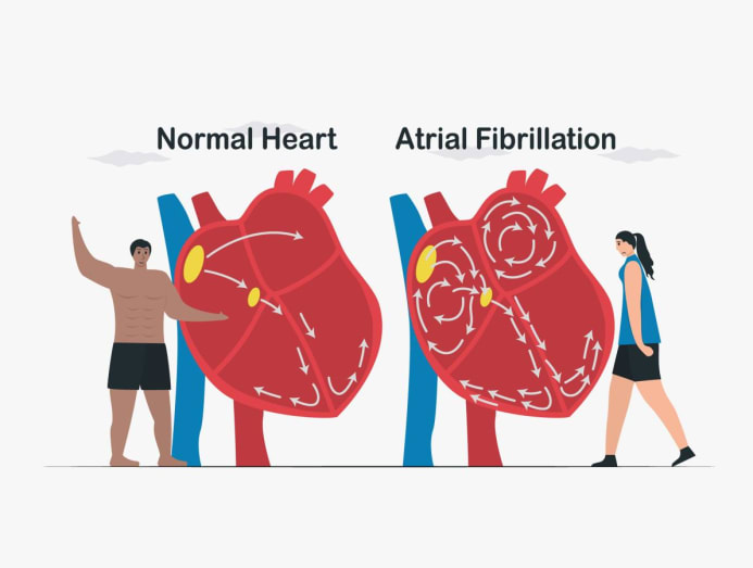 How do I know if I have atrial fibrillation? What are symptoms, tests ...