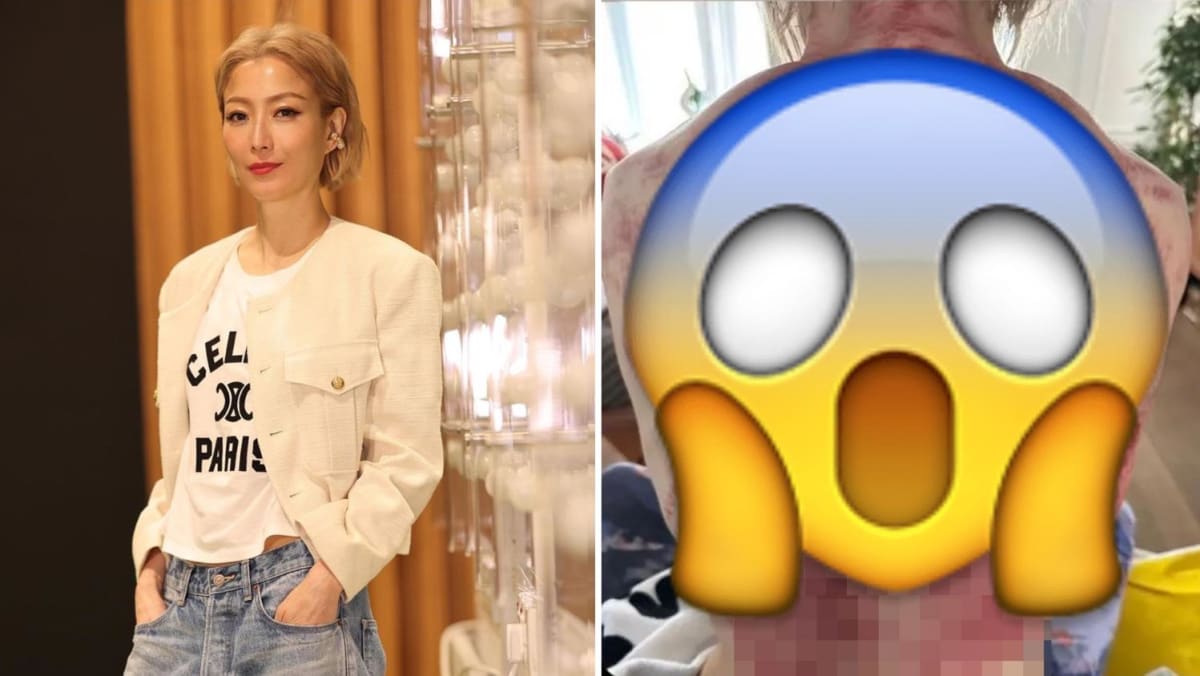 Sammi Cheng Posted A Pic Of Her Post-Gua Sha Back & It Looks Like A ...