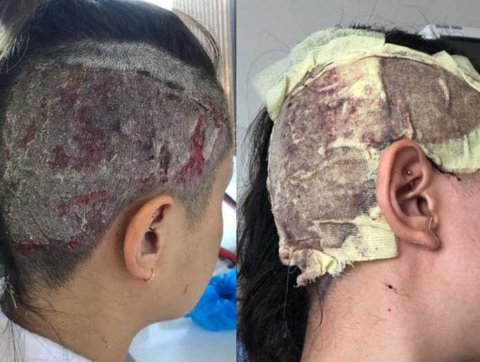 Burn survivor Charlene Chew on fitness and 'inner work'