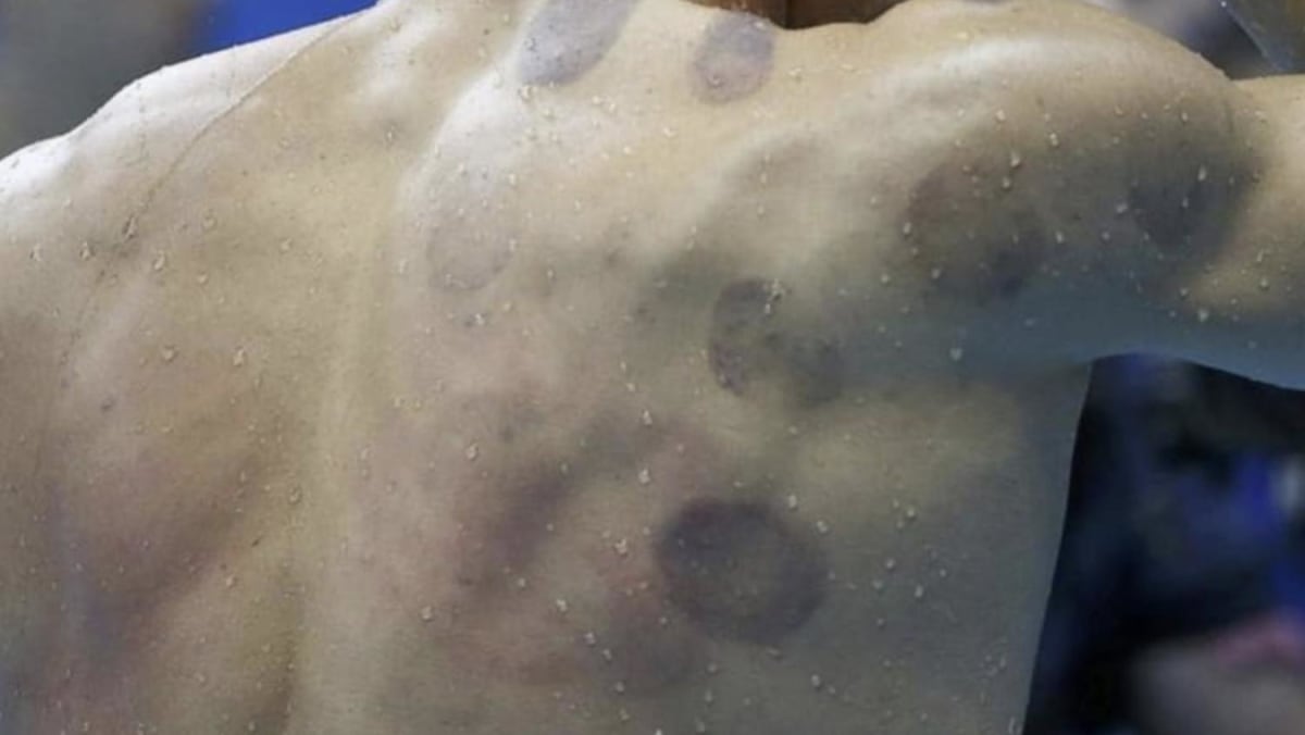 Explainer: Cupping therapy caused horrific burns to Yanxi Palace ...