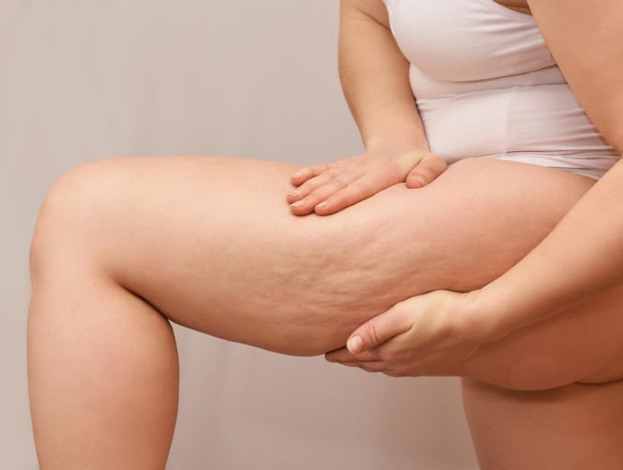 The truth about cellulite: What is it, why do we get it and what can we ...