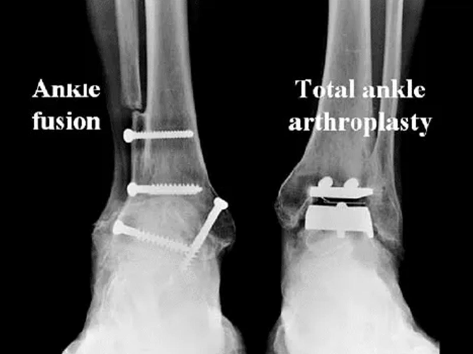 Why are some people more prone to ankle sprains? Causes, treatment and ...