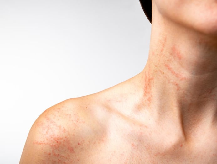 Do you get itchy, swollen, red rashes when you’re outside? You may have ...