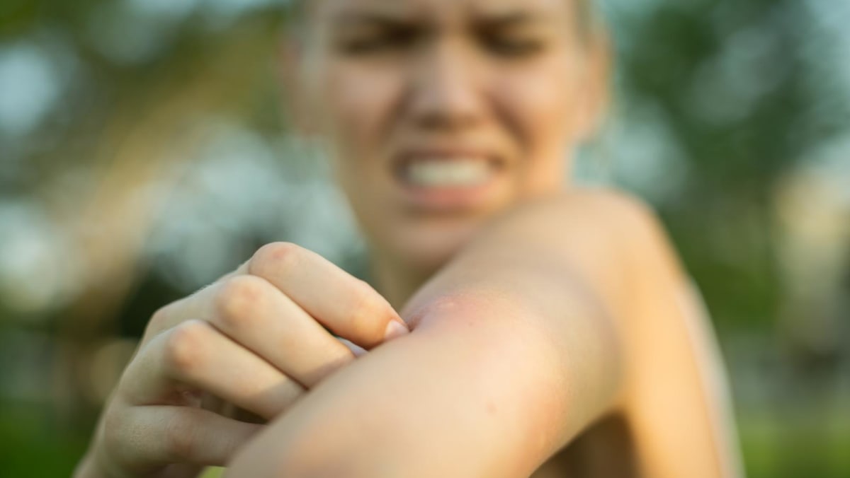How to treat insect bites and stings from fire ants, hornets, bed bugs ...