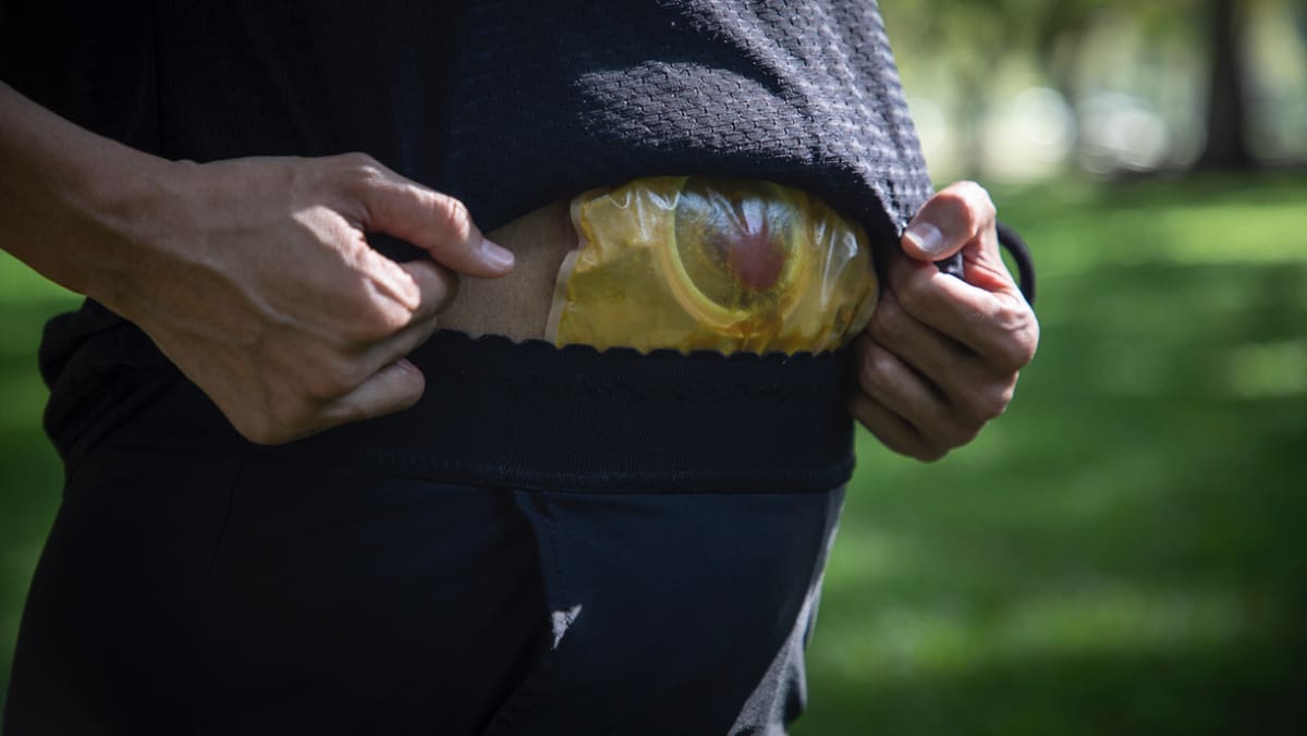 Living with a stoma pouch: What a 39-year-old colorectal cancer ...