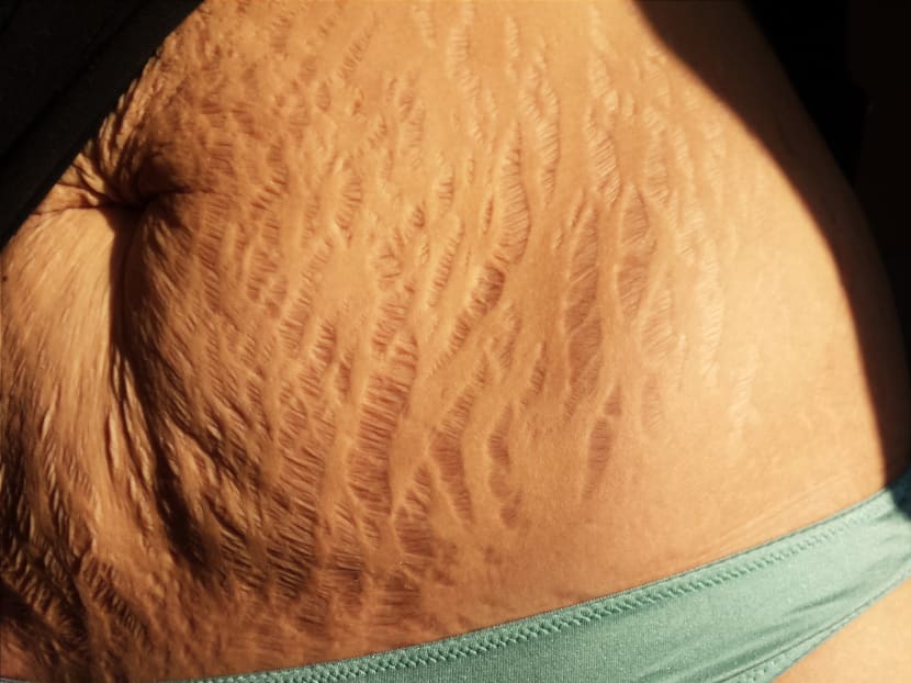 womens stretch marks