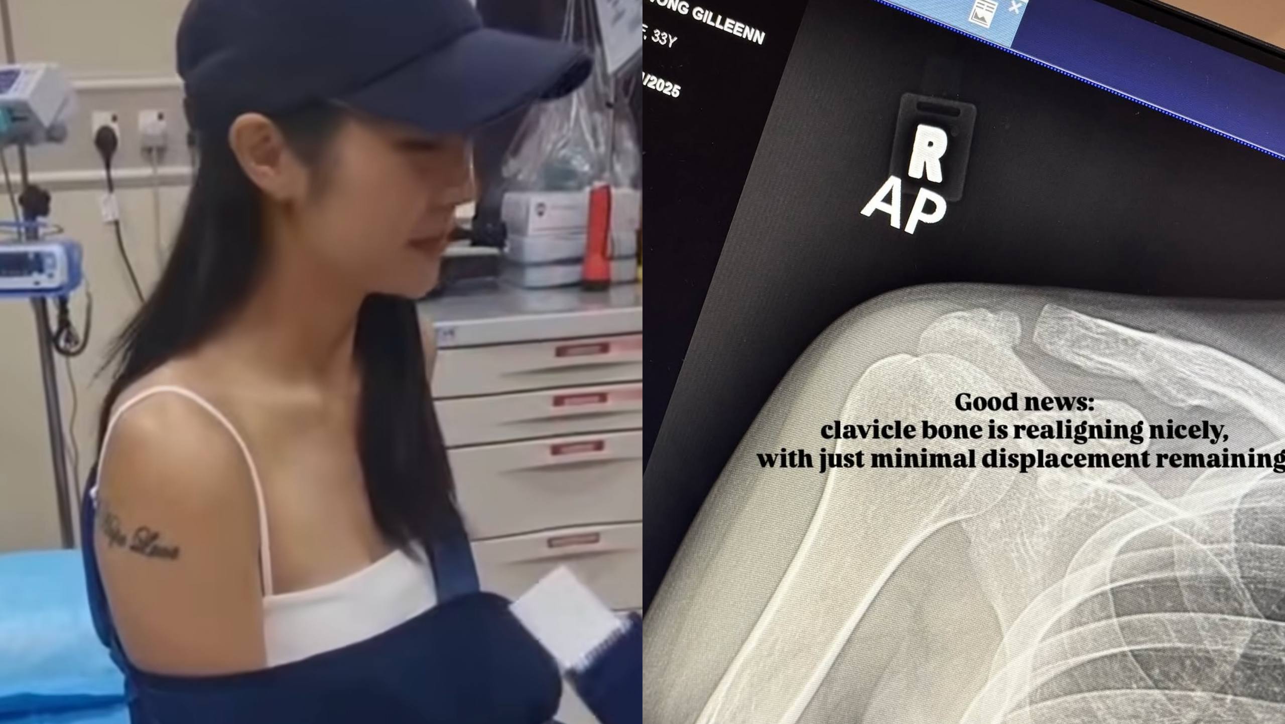 Ferlyn G Fractured Her Collarbone While Preparing For A Role, Cried In ...