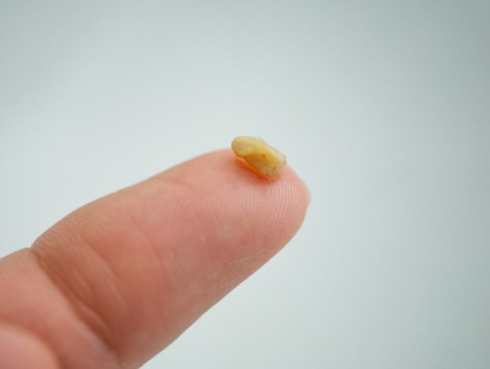 What are tonsil stones and do they need to be removed? - CNA Lifestyle