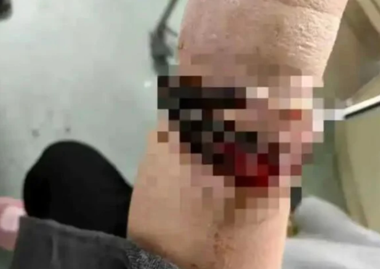 Woman’s Bracelet Gets Lodged In Her Flesh After Wearing It For 10 Years ...