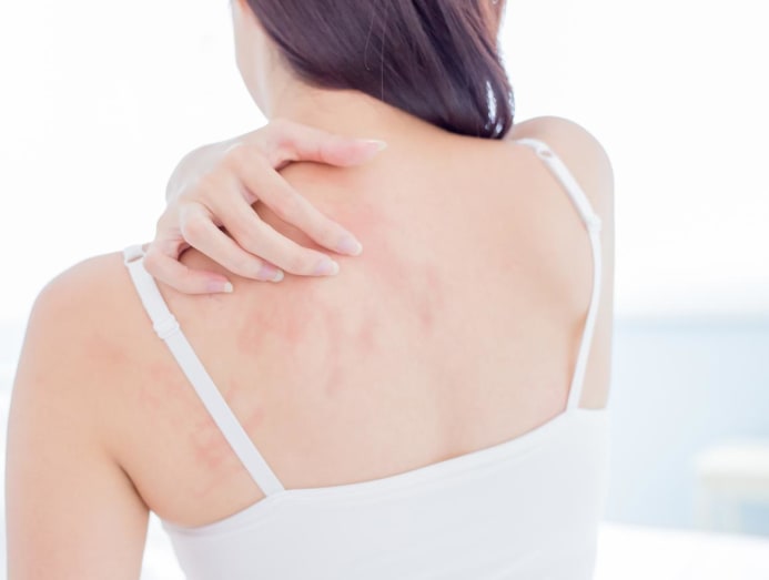 Do you get itchy, swollen, red rashes when you’re outside? You may have ...