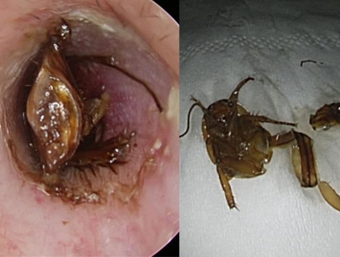 What should you do if a cockroach crawls inside your ear? Don’t try to ...
